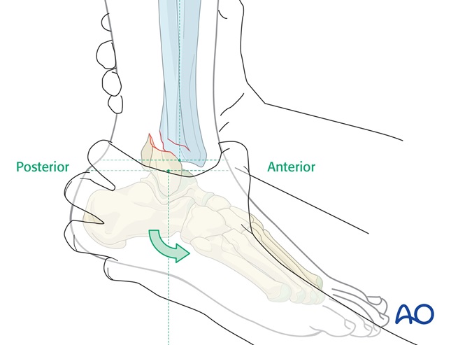 Malleoli fracture management with minimal resources