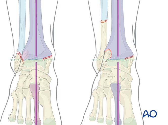 Malleoli fracture management with minimal resources