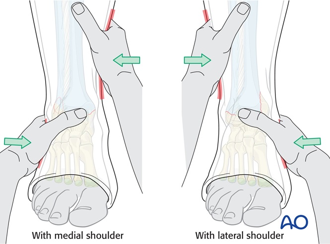Malleoli fracture management with minimal resources