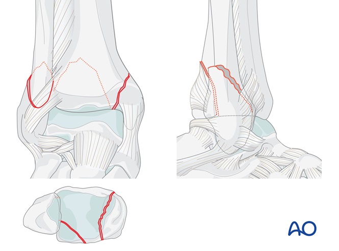 ORIF for Transsyndesmotic, posterior, lateral simple, and medial fractures