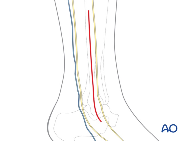 ORIF for Transsyndesmotic, posterior, lateral simple, and medial fractures