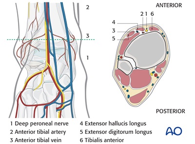 Safe zones in the malleoli for anterior approach