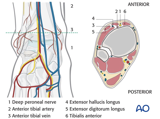 Safe zones in the malleoli for anterior approach