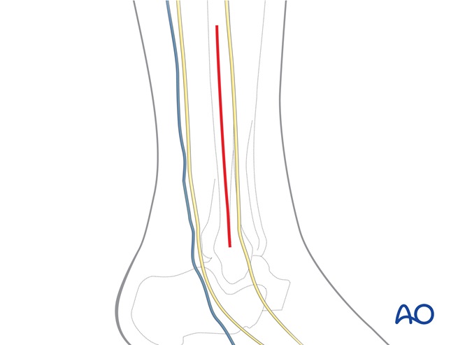 ORIF for Suprasyndesmotic, simple fibular fracture, medial injury ...