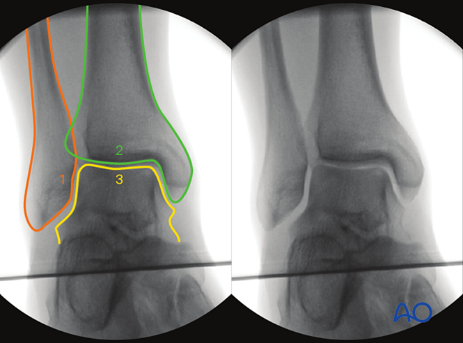Intraoperative imaging of the ankle