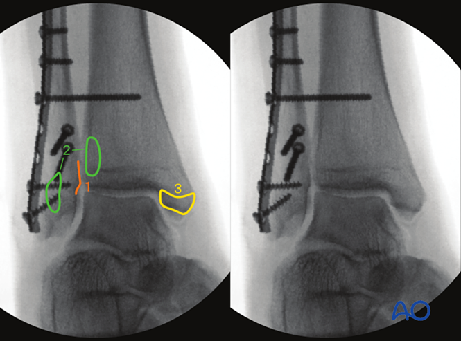 Intraoperative imaging of the ankle