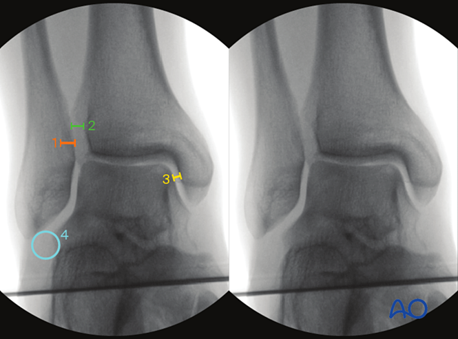 Intraoperative imaging of the ankle
