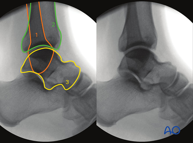Intraoperative imaging of the ankle