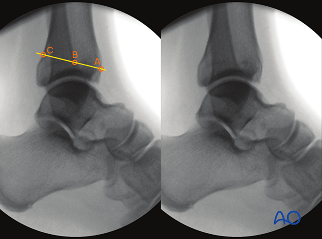 Intraoperative imaging of the ankle