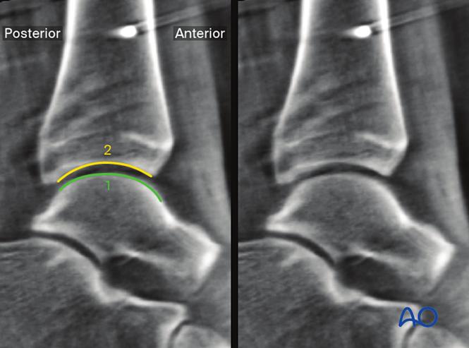 Intraoperative imaging of the ankle