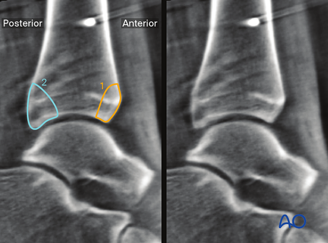 Intraoperative imaging of the ankle