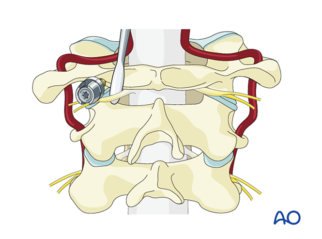 Posterior access to C1–C2