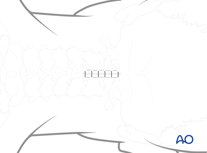 Posterior access to C1–C2