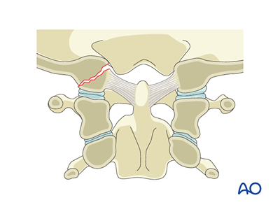 AO Spine upper cervical injuries classification system