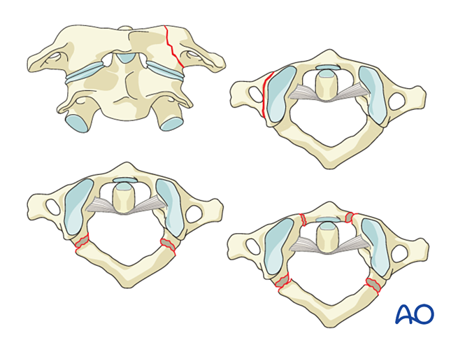 AO Spine upper cervical injuries classification system