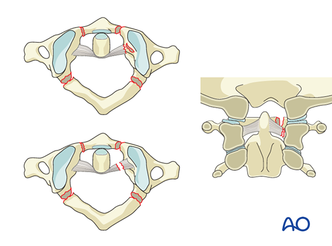 AO Spine upper cervical injuries classification system