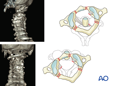 AO Spine upper cervical injuries classification system
