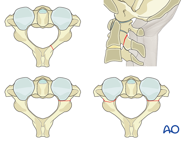 AO Spine upper cervical injuries classification system