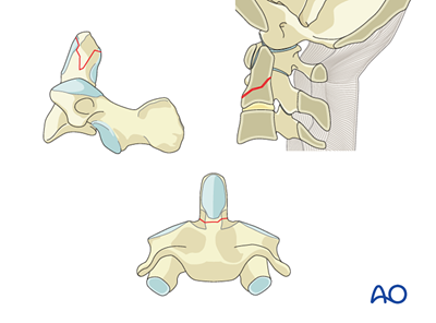 AO Spine upper cervical injuries classification system