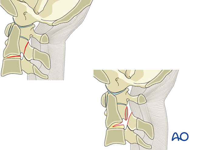 AO Spine upper cervical injuries classification system