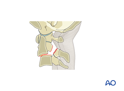 AO Spine upper cervical injuries classification system