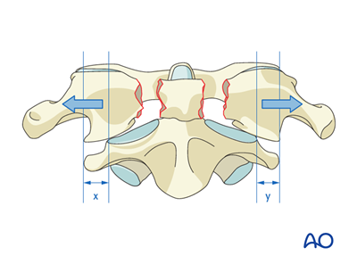 AO Spine upper cervical injuries classification system
