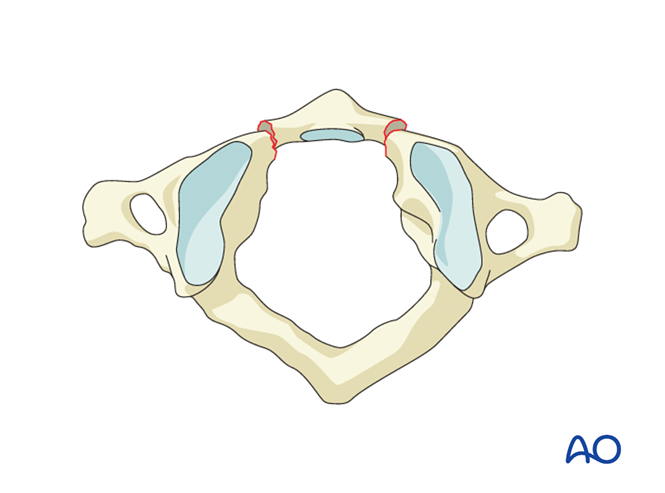 AO Spine upper cervical injuries classification system