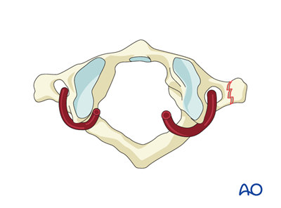 AO Spine upper cervical injuries classification system