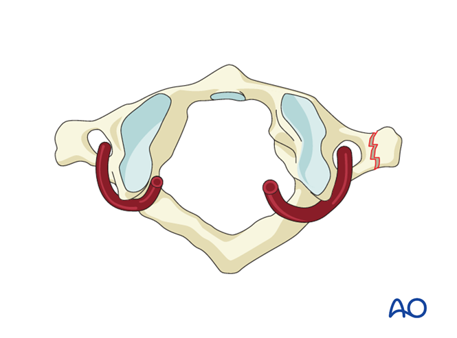 Region II: C1 ring and C1–C2 joint - Type A: Isolated bony injury