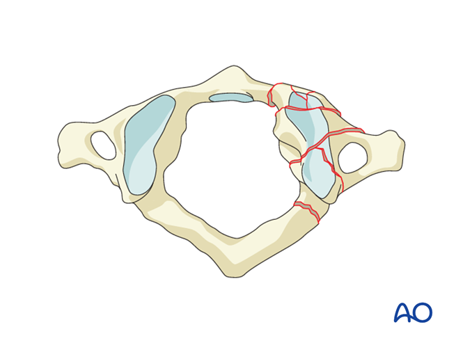 AO Spine upper cervical injuries classification system
