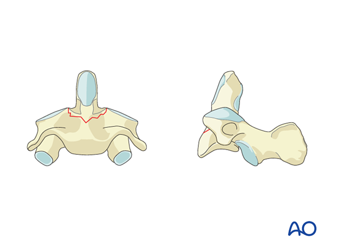 AO Spine upper cervical injuries classification system