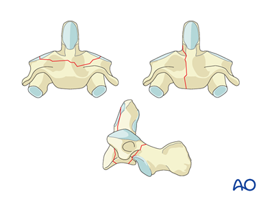 AO Spine upper cervical injuries classification system