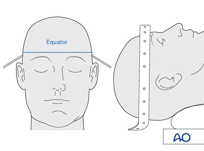 Halo vest for Region II Type B: Nondisplaced ligamentous injury