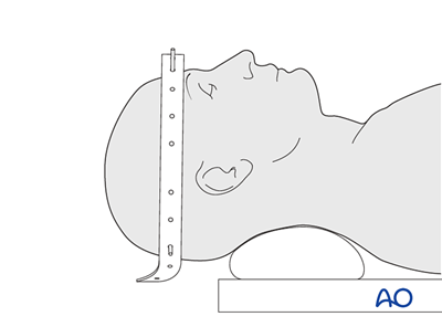 Halo vest for Region I Type B: Nondisplaced ligamentous injury ...