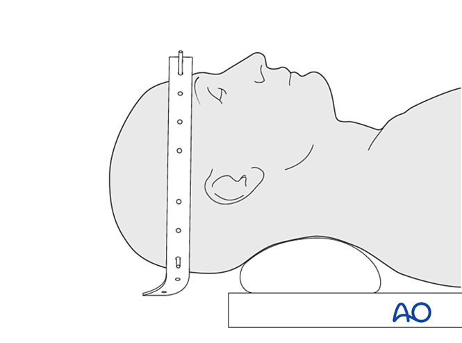 Halo vest for Region I Type B: Nondisplaced ligamentous injury ...