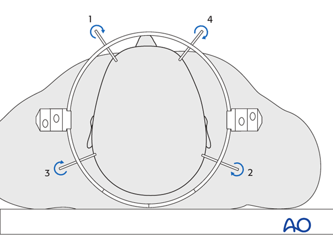 Halo vest for Region I Type B: Nondisplaced ligamentous injury ...