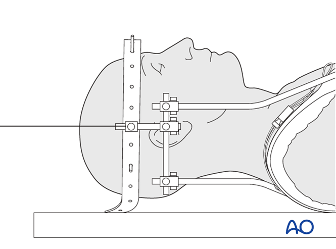 Halo vest for Region I Type B: Nondisplaced ligamentous injury ...