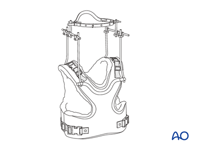 Halo vest for Region II Type B: Nondisplaced ligamentous injury