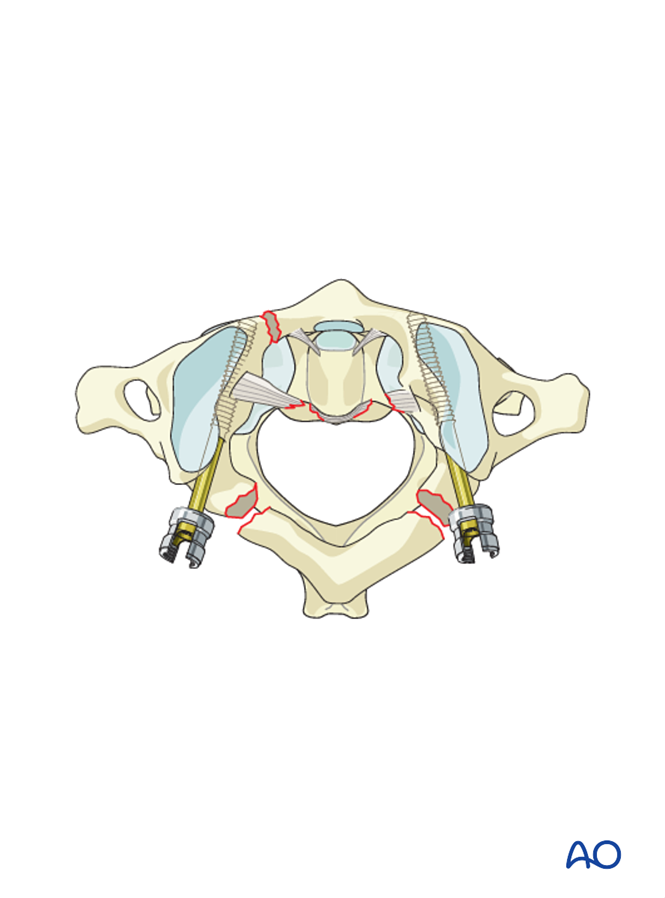 Posterior C1–C2 fusion for Region II Type B: Nondisplaced ligamentous ...