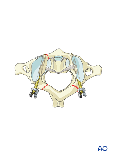 Posterior C1–C2 fusion for Region II Type B: Nondisplaced ligamentous ...