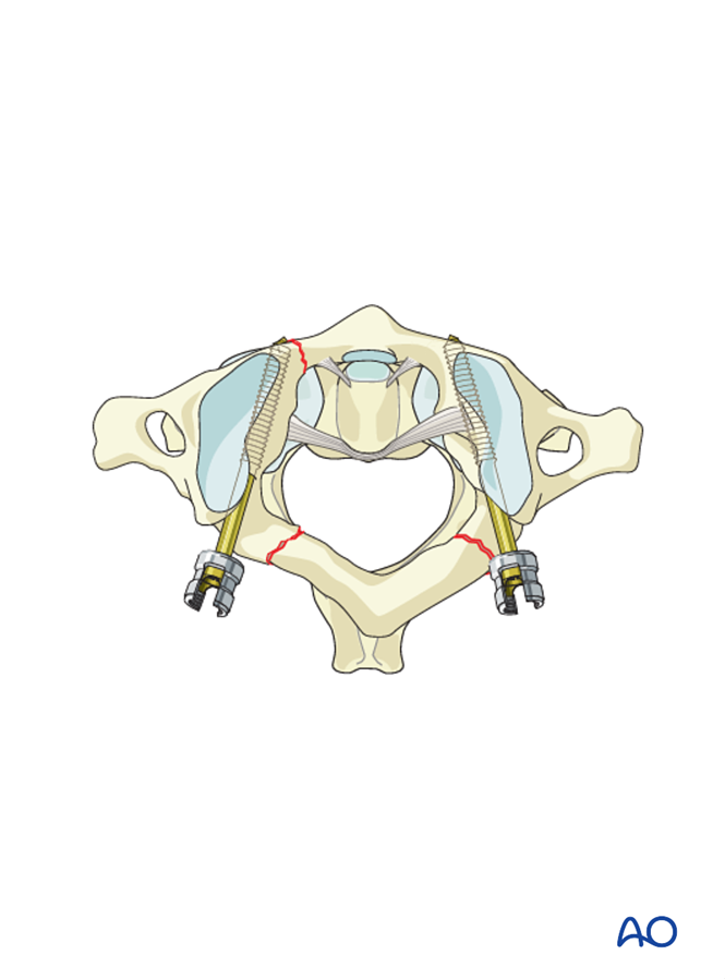 Posterior C1–C2 fusion for Region II Type B: Nondisplaced ligamentous ...