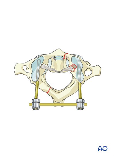 Posterior C1–C2 fusion for Region II Type C: Translation injury of the ...