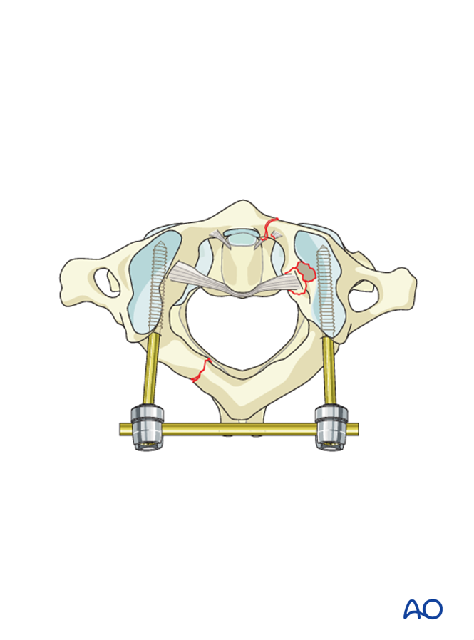 Posterior C1–C2 fusion for Region II Type B: Nondisplaced ligamentous ...