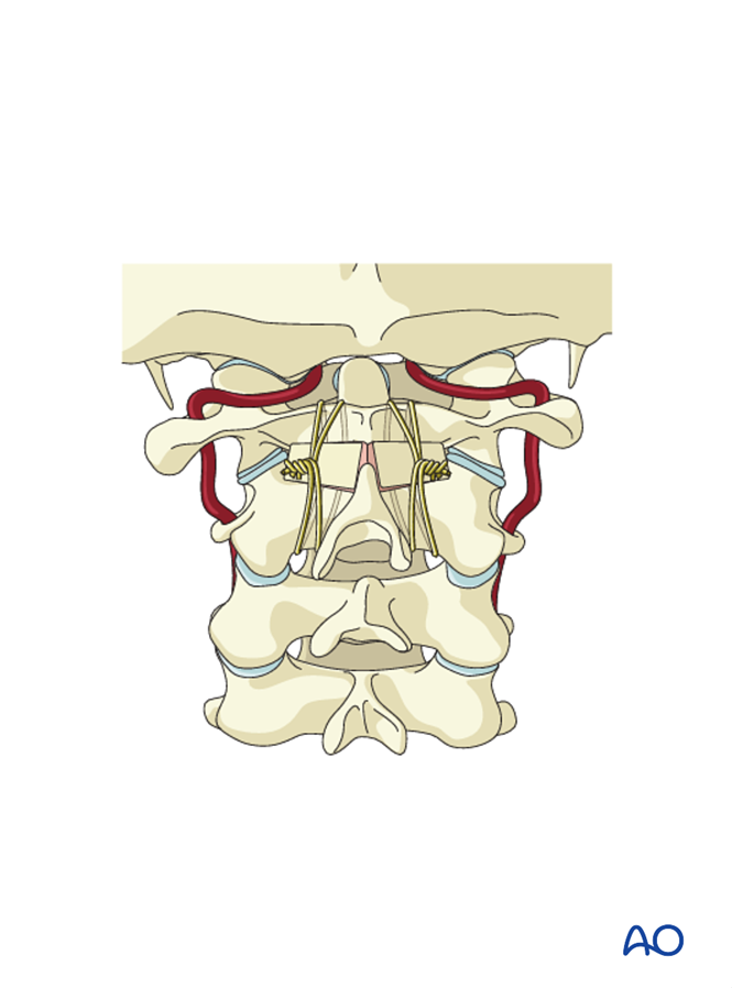 Posterior C1–C2 fusion for Region II Type B: Nondisplaced ligamentous ...