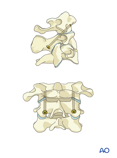 Posterior C1–C2 fusion for Region III Type A: Isolated bony injury of C2