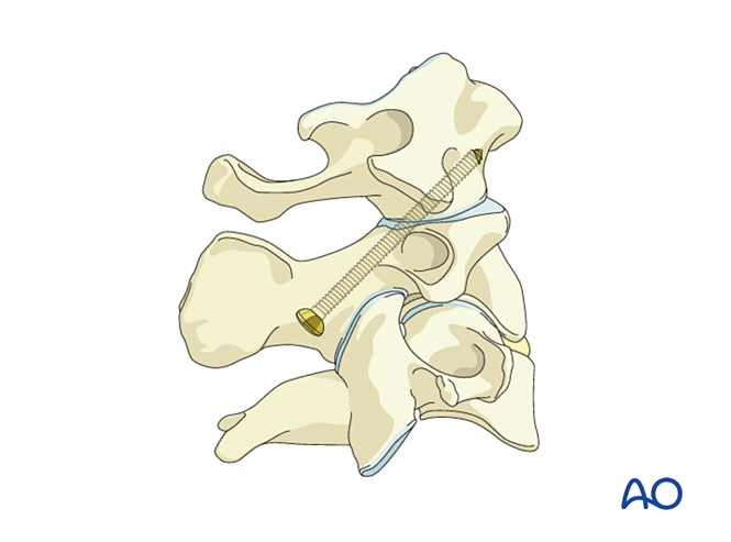 Basic techniques for management of occipitocervical spine trauma
