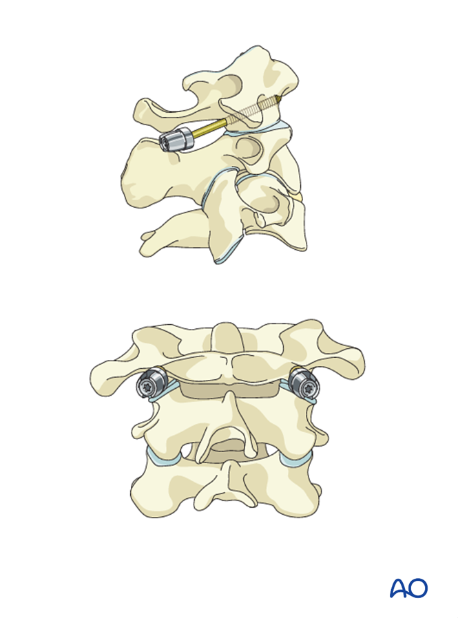 Posterior C1–C2 fusion for Region II Type C: Translation injury of the C1–C2 joint