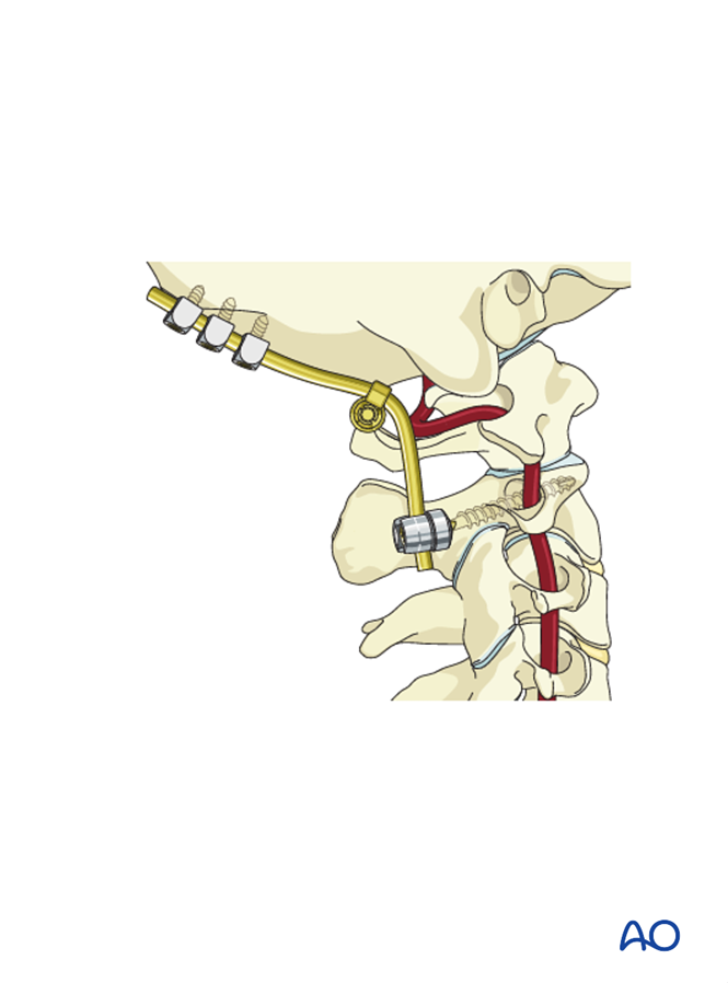 Posterior C1–C2 fusion for Region II Type B: Nondisplaced ligamentous ...