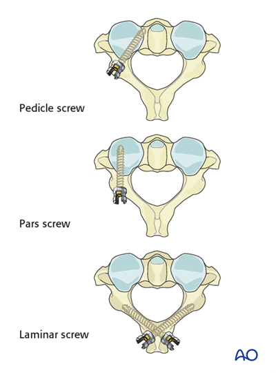 Posterior C1–C2 fusion for Region II Type B: Nondisplaced ligamentous ...