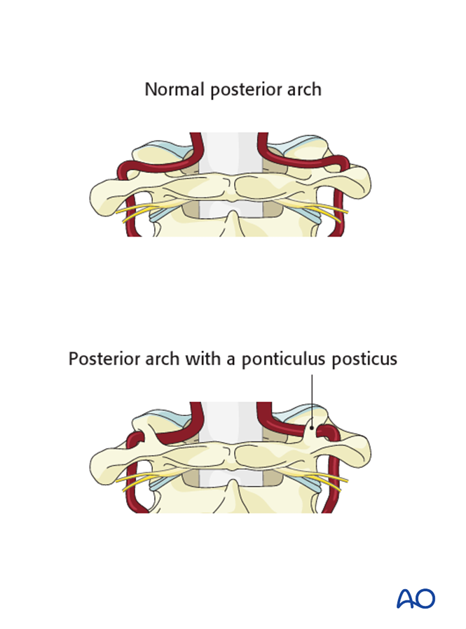 Posterior C1–C2 fusion for Region II Type B: Nondisplaced ligamentous ...